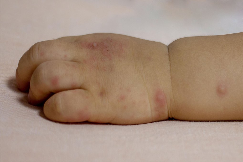 Rashes in babies and children - NHS