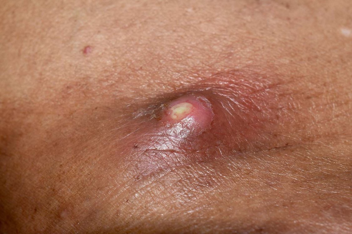 Skin abscess - NHS