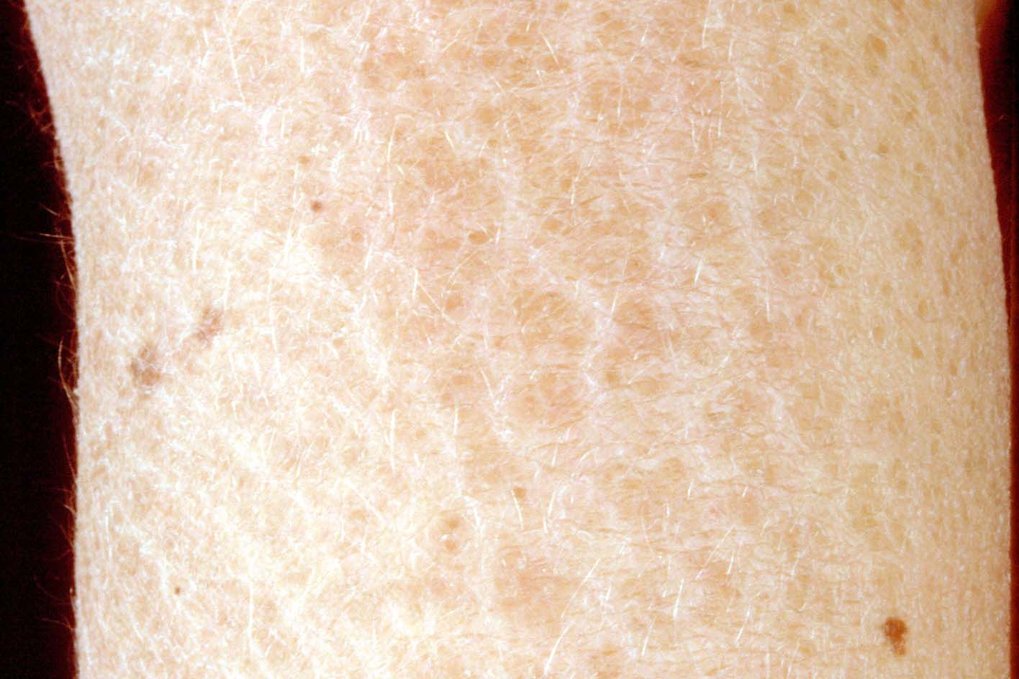 Ichthyosis - NHS