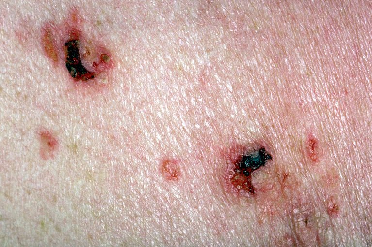 Pemphigus vulgaris - NHS