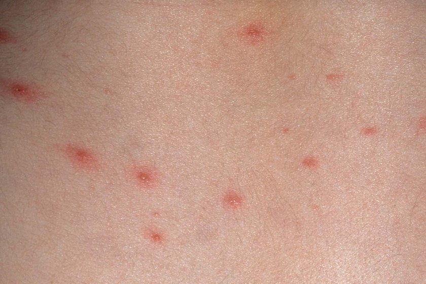 Chickenpox - NHS
