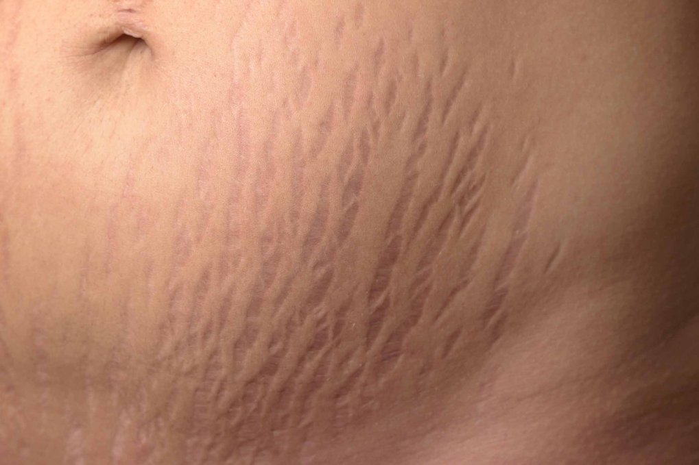 Stretch marks - NHS