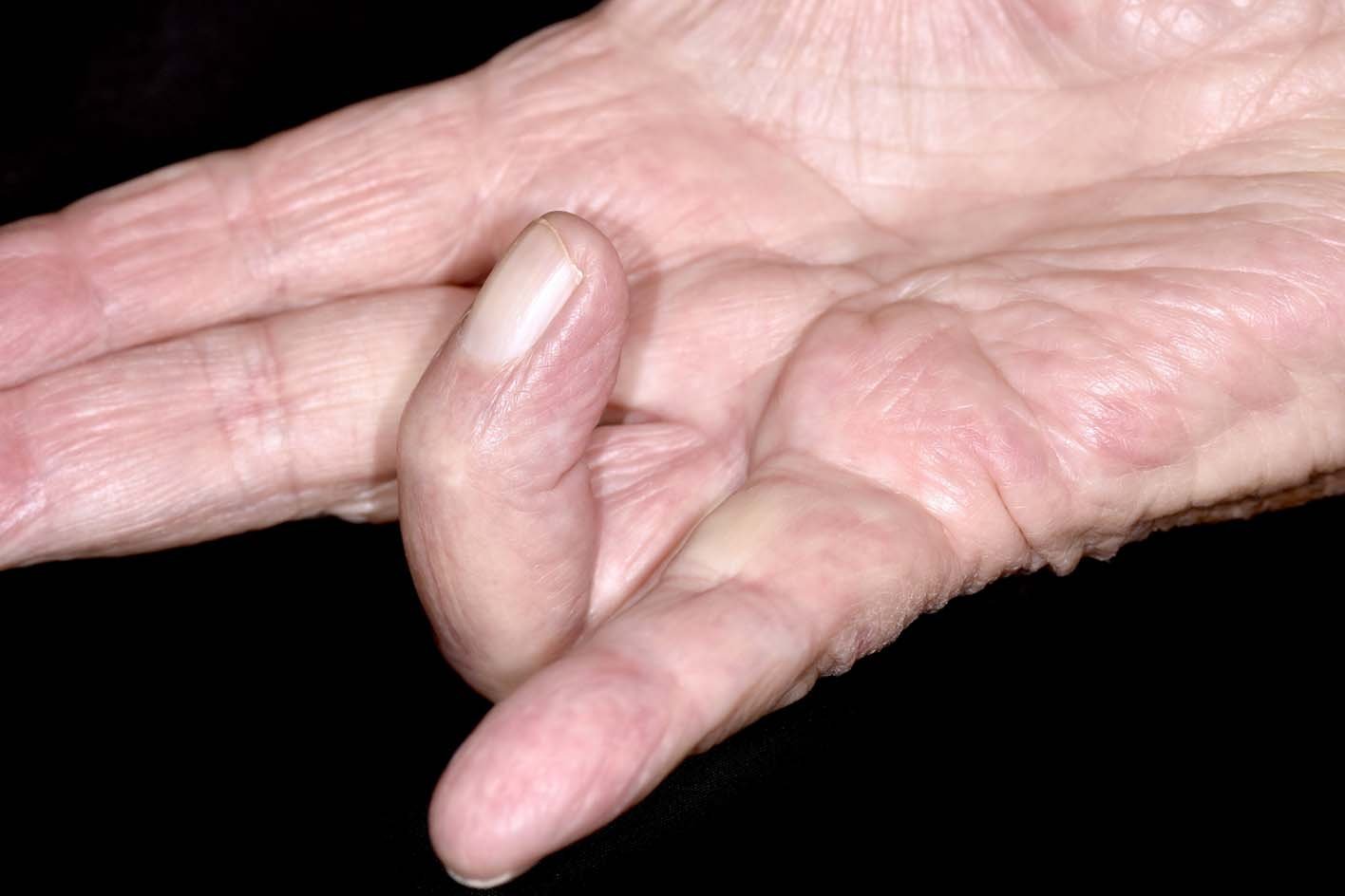 Dupuytren's contracture - NHS