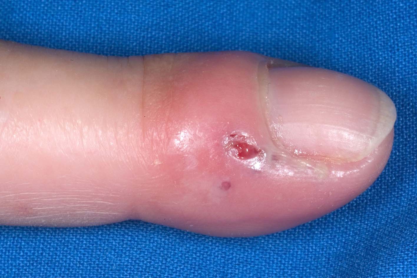 Herpetic whitlow (whitlow finger) - NHS