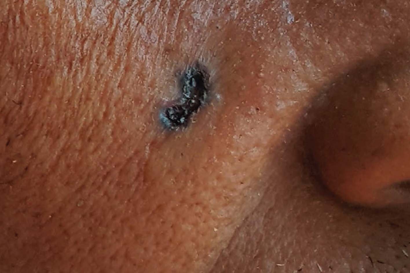 Symptoms of non-melanoma skin cancer - NHS
