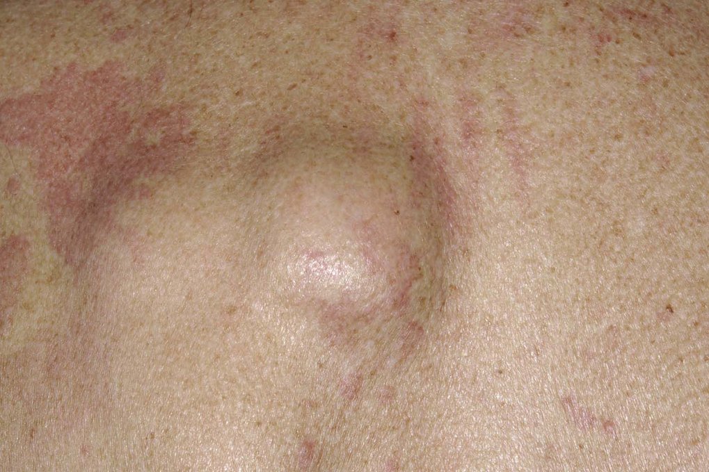 Lipoma - NHS