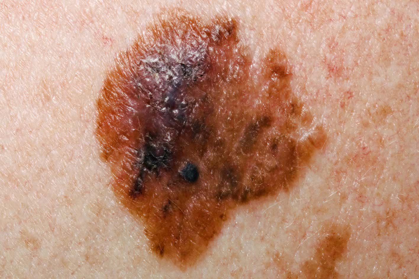 Melanoma skin cancer - Symptoms - NHS