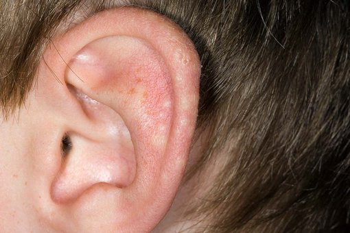 Polymorphic light eruption - NHS