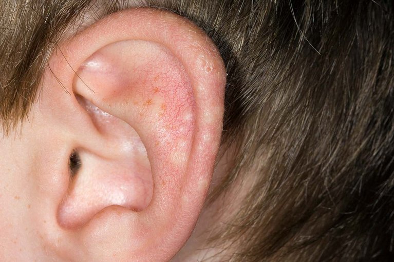 Polymorphic light eruption - NHS