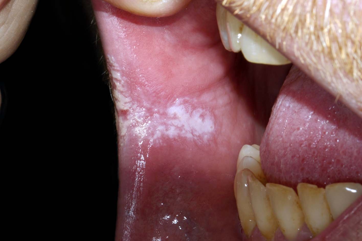 Leukoplakia - NHS