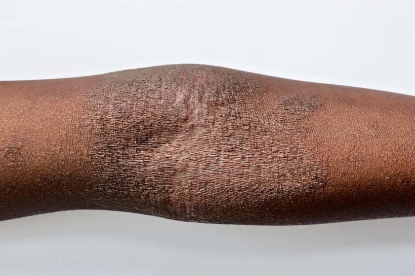 Atopic eczema - NHS