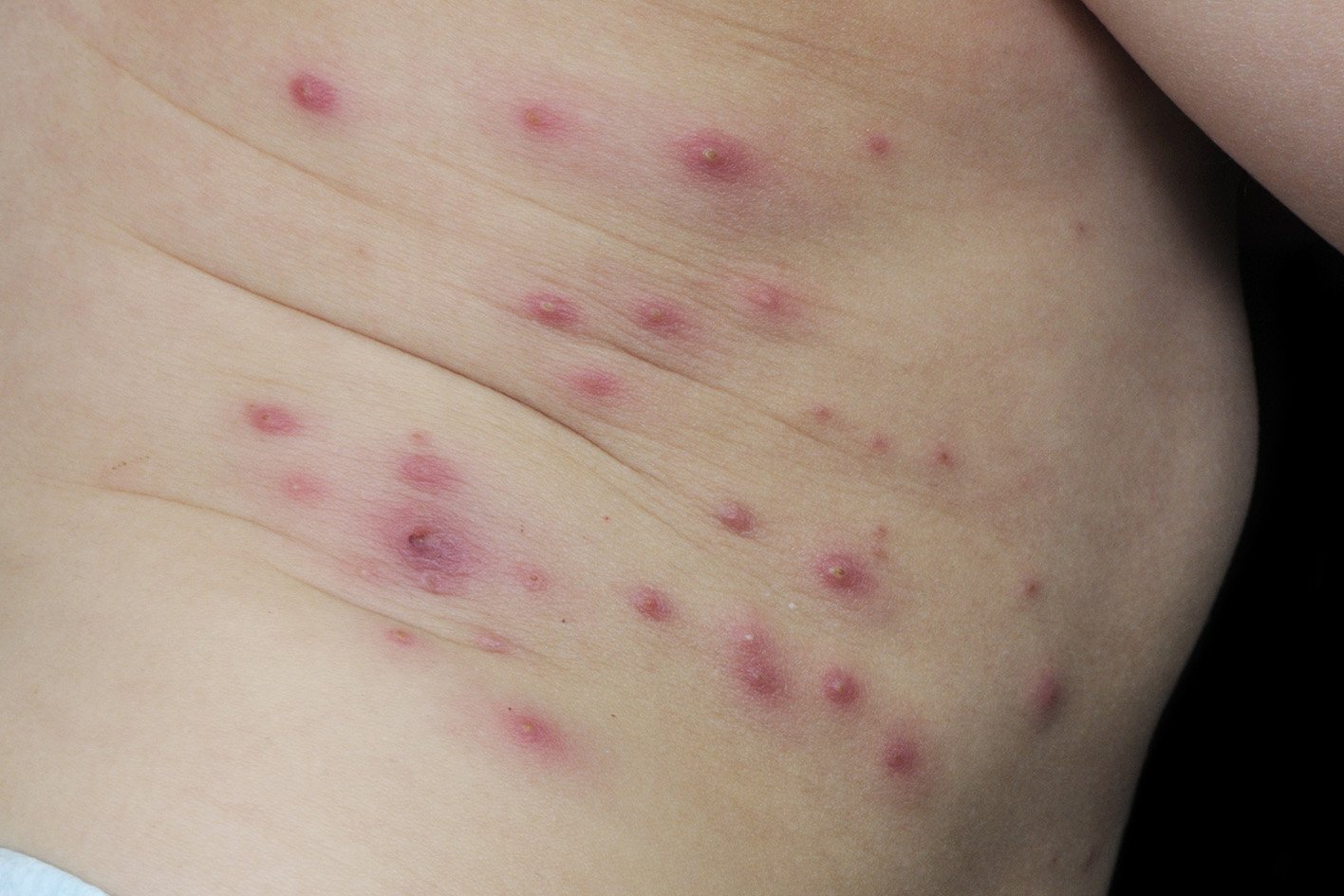Impetigo NHS Impetigo NHS