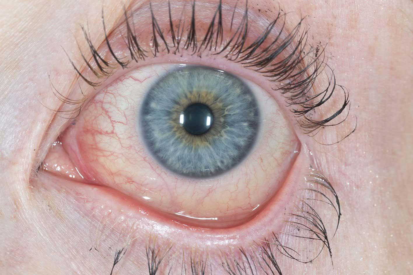 Conjunctivitis - NHS