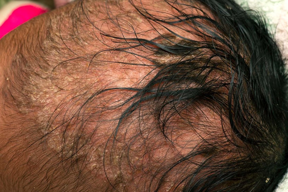 Cradle cap - NHS