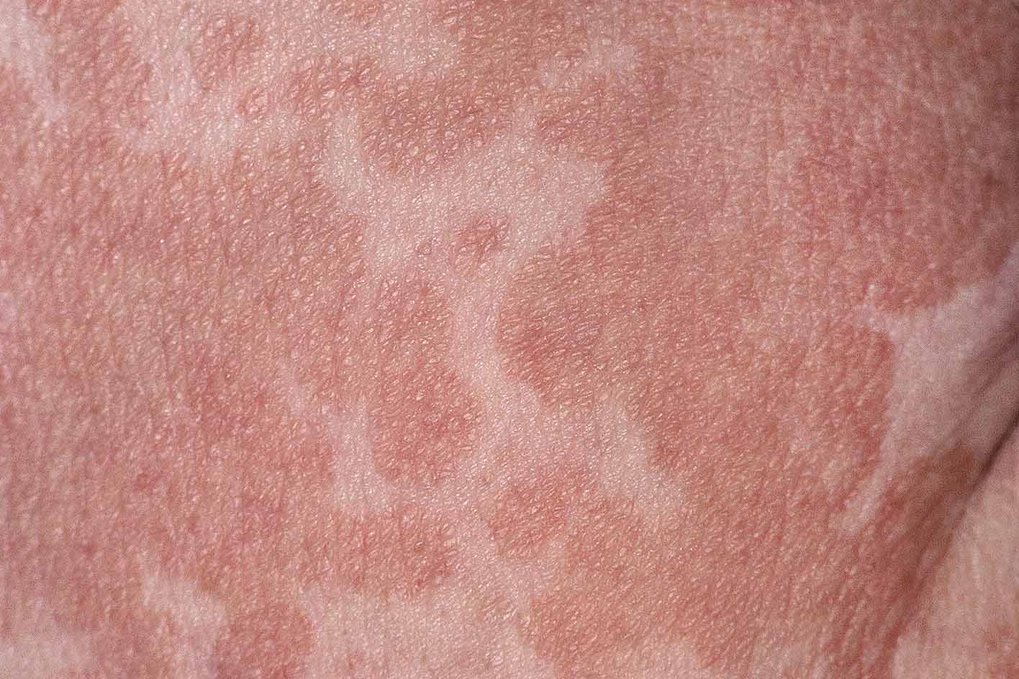 Pityriasis versicolor - NHS
