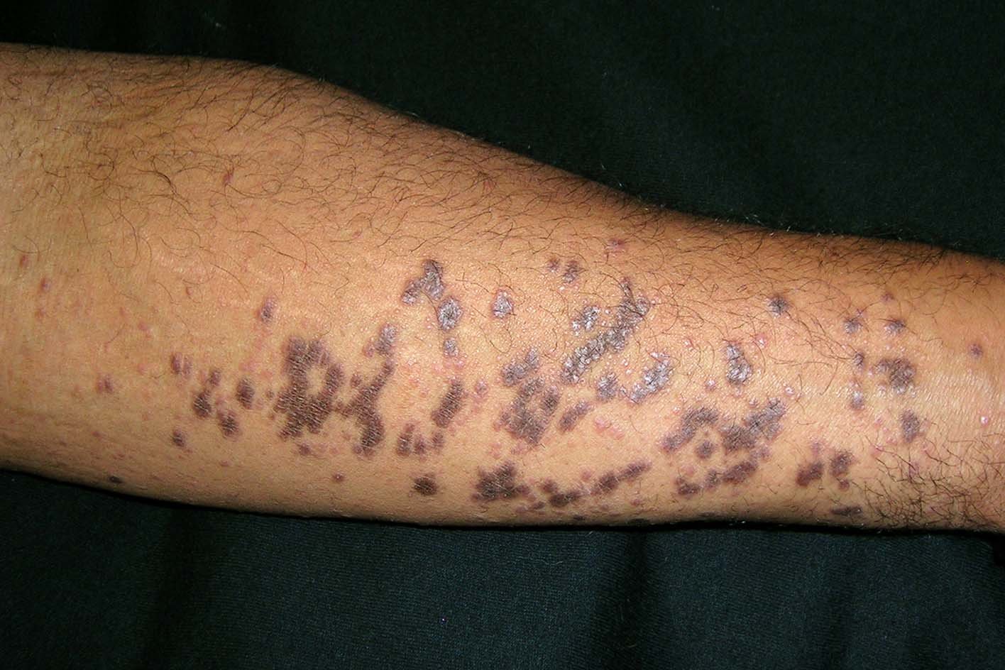 Lichen planus - NHS