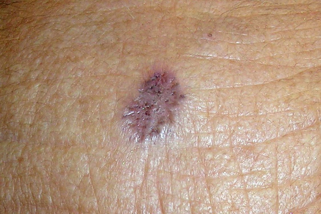 Symptoms of non-melanoma skin cancer - NHS