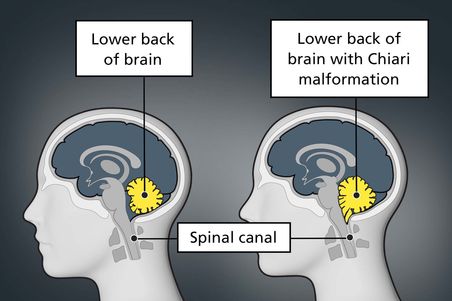 Chiari malformation - NHS