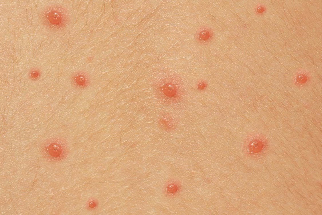 Chickenpox NHS