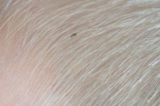 Head lice and nits - NHS