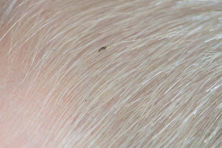 Head lice and nits - NHS