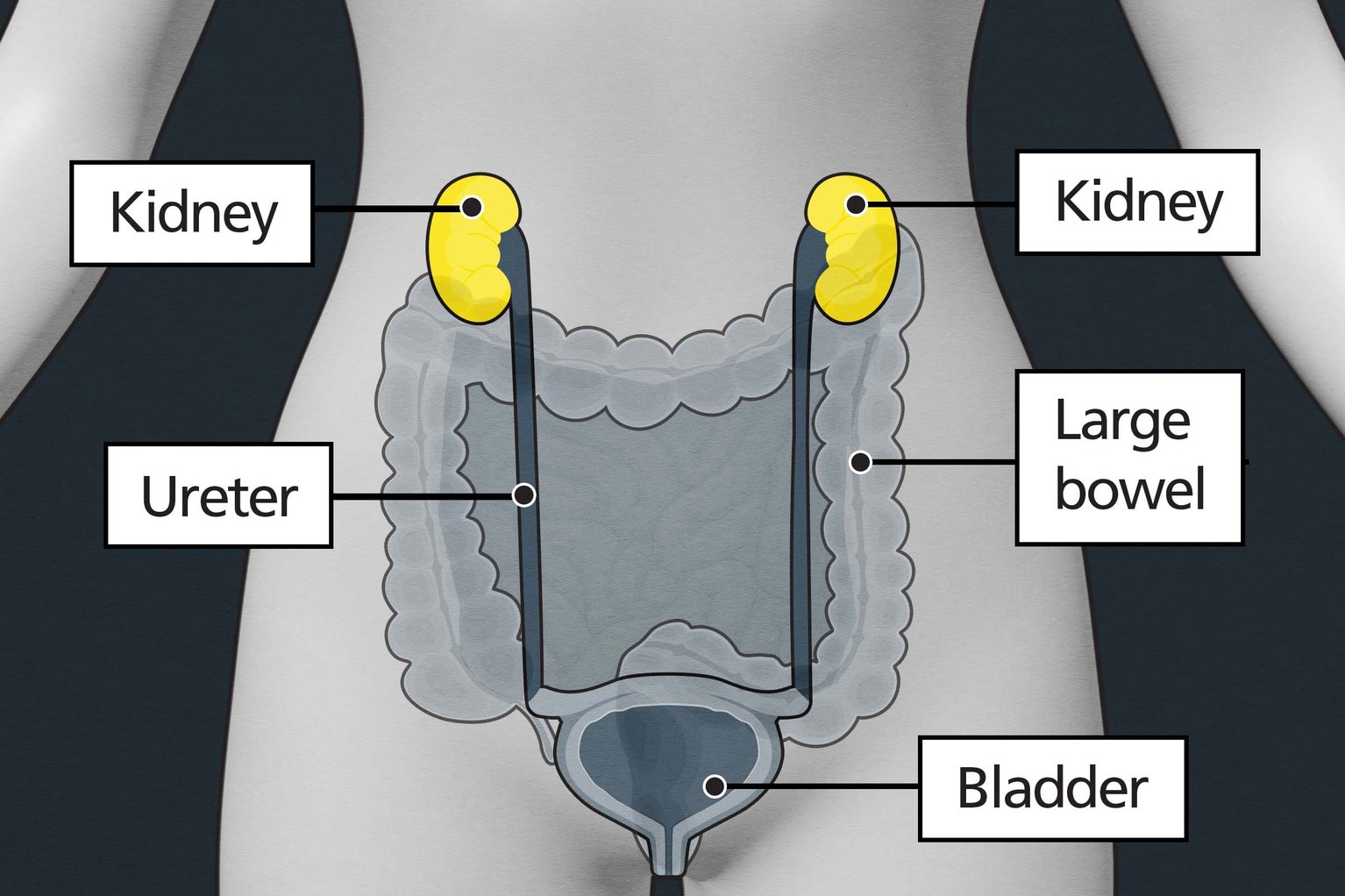 What is kidney cancer? - NHS