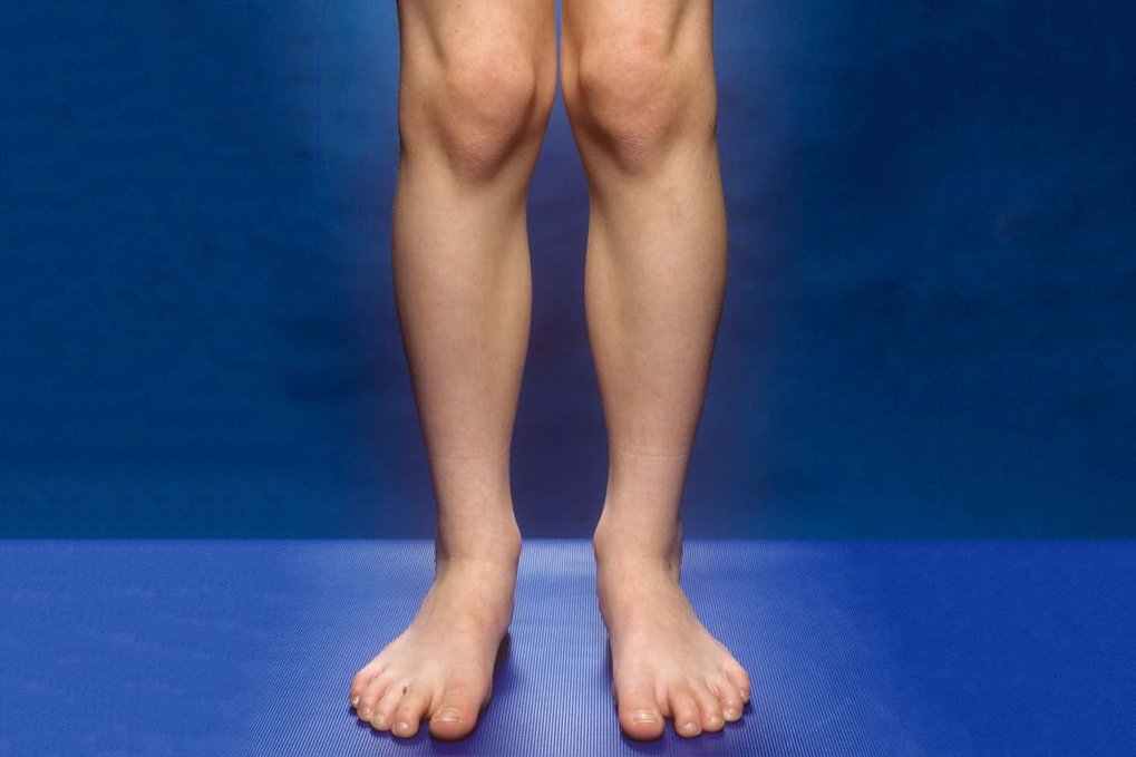 Knock knees - NHS