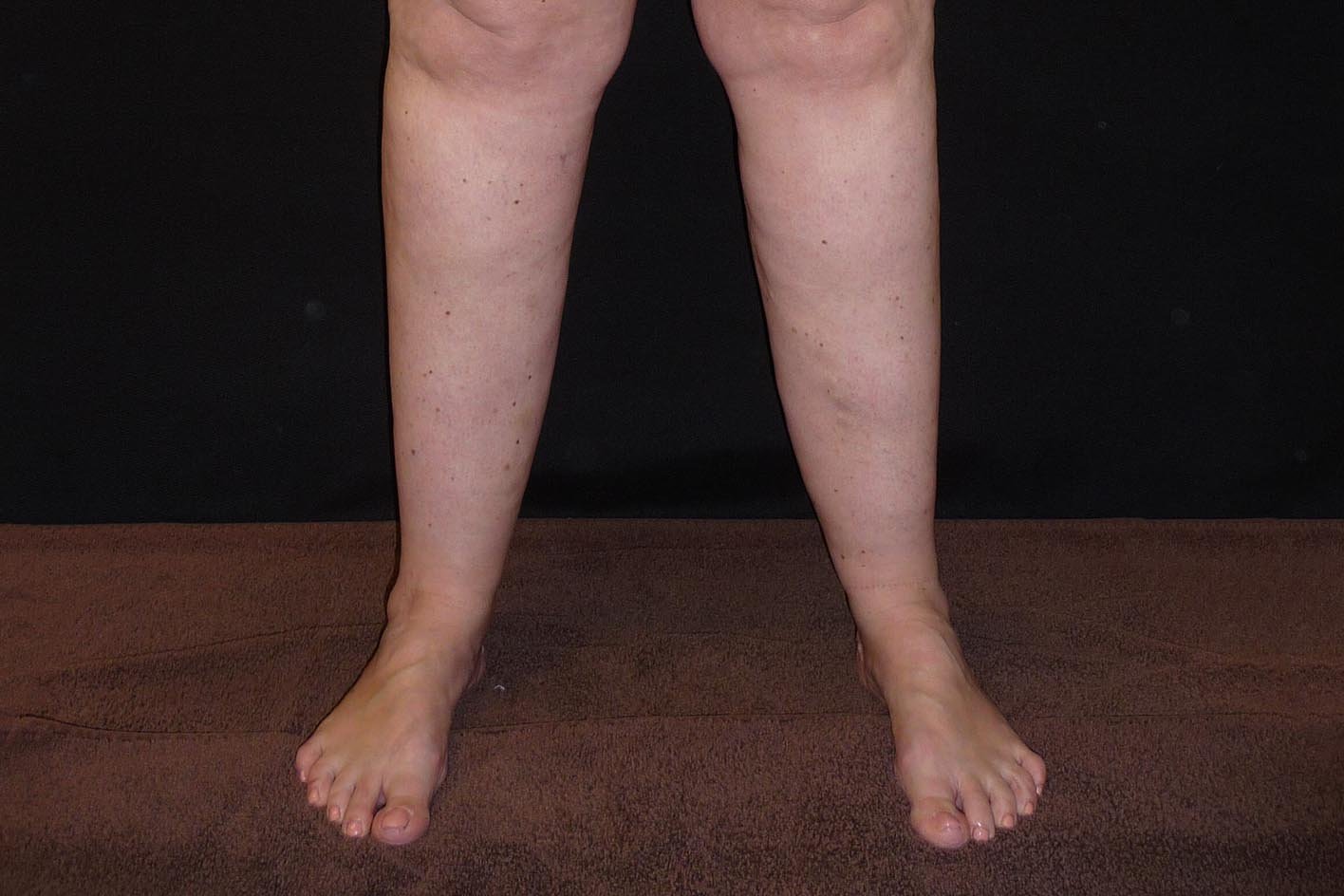 Lipoedema - NHS