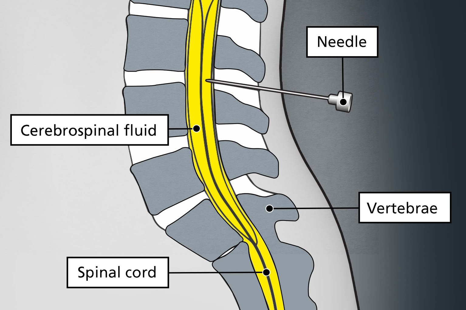 Lumbar puncture - NHS