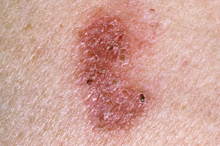 Symptoms of non-melanoma skin cancer - NHS