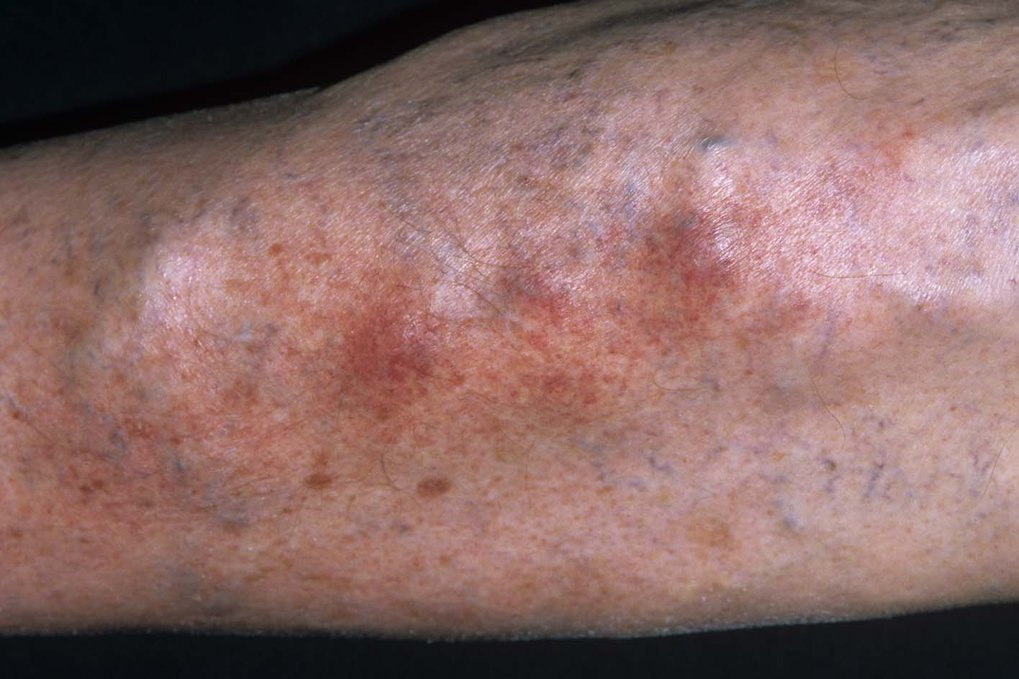 Phlebitis (superficial thrombophlebitis) - NHS