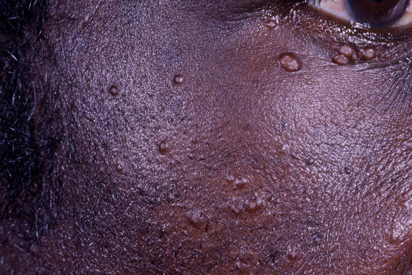 Molluscum contagiosum - NHS