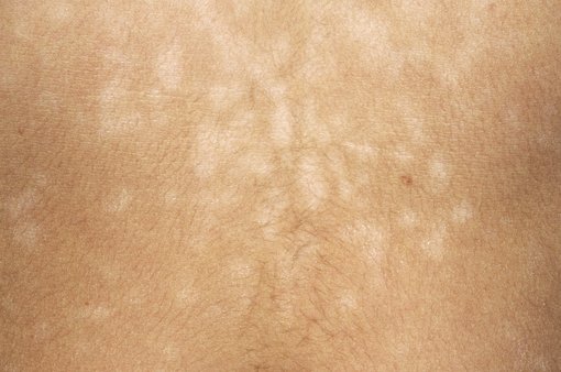 How Do You Know Tinea Versicolor Fungus Is Killed - Dow Samelle