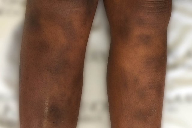 Erythema nodosum - NHS