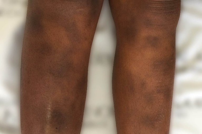 Erythema nodosum - NHS