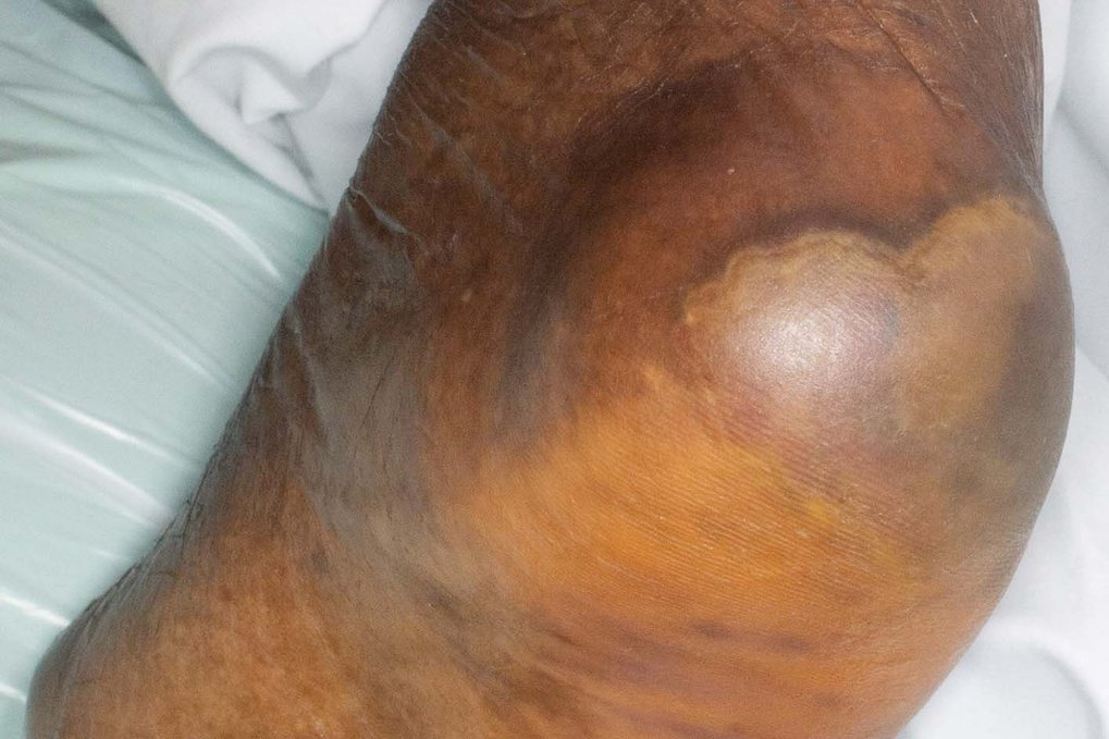 Pressure ulcers (pressure sores) - NHS