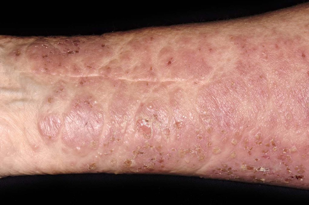 Bullous pemphigoid - NHS