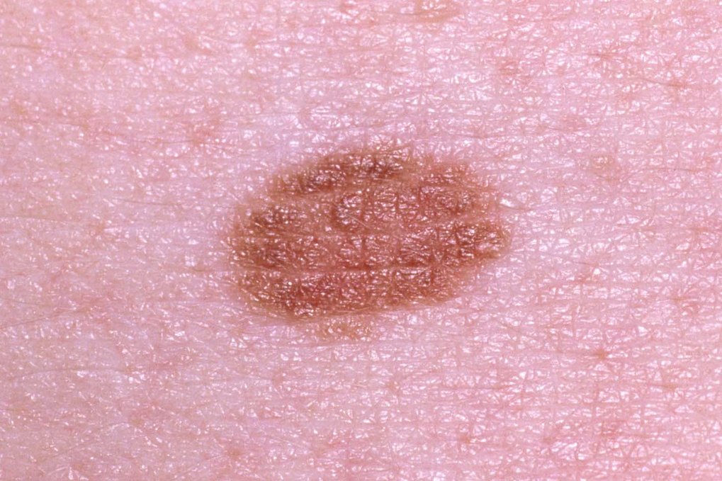 Moles - NHS