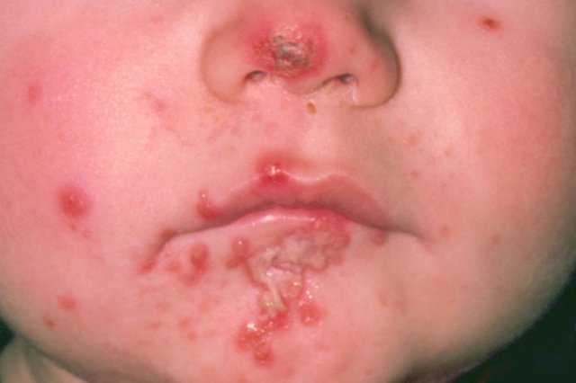 Impetigo - NHS