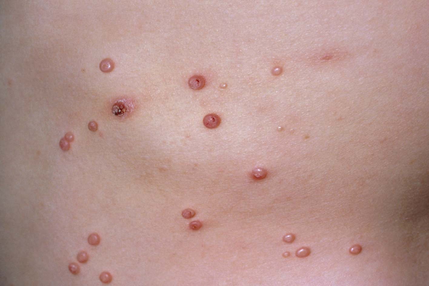Molluscum contagiosum - NHS