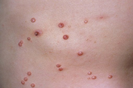 Molluscum contagiosum - NHS
