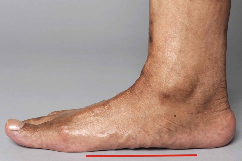 Flat feet - NHS