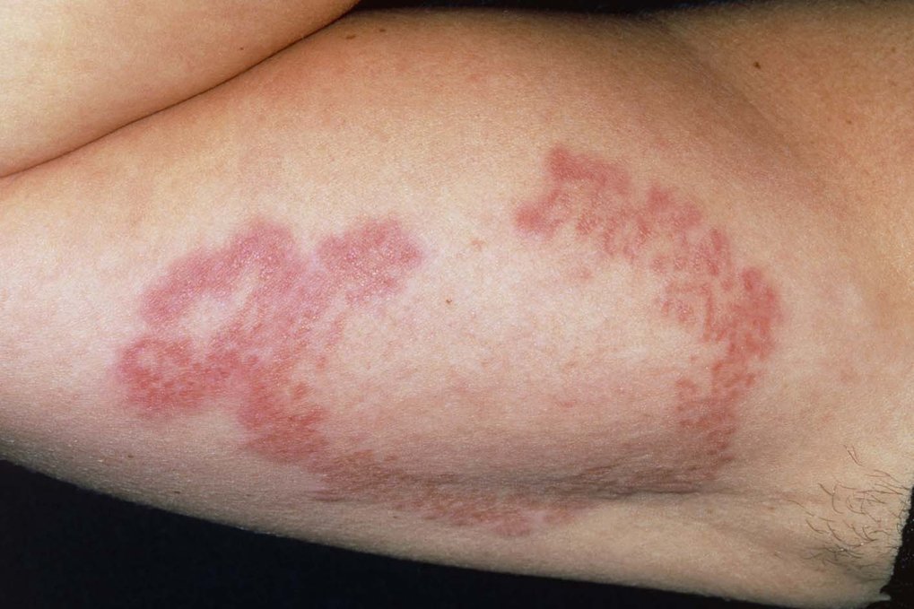 Granuloma annulare - NHS