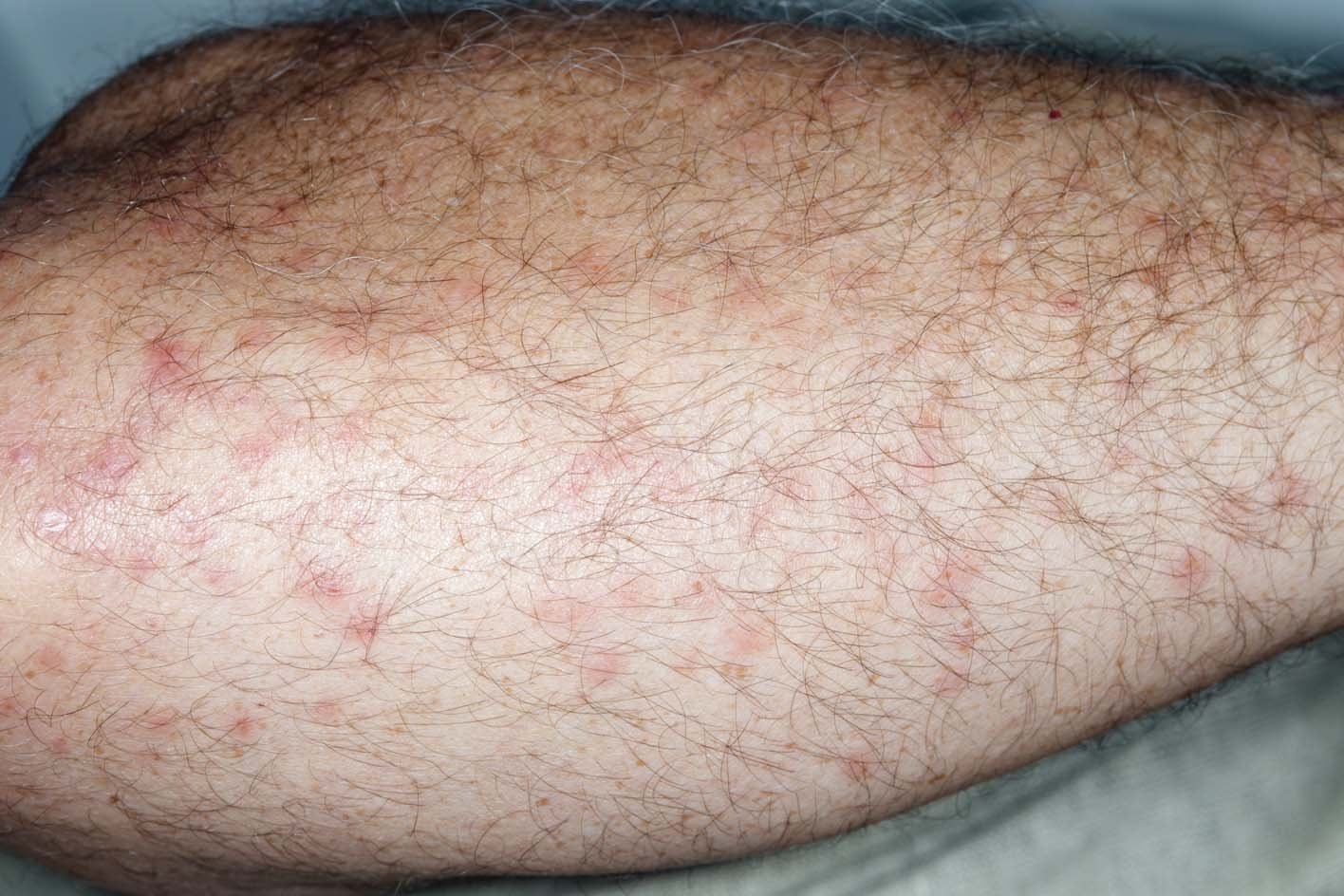 Insect bites and stings - NHS