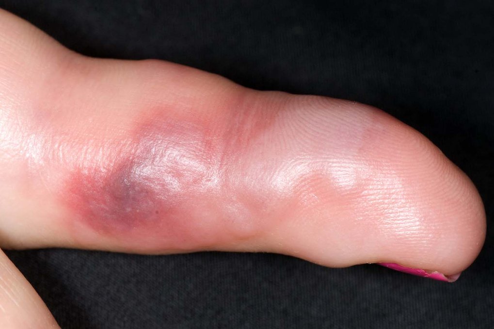 Insect bites and stings - NHS