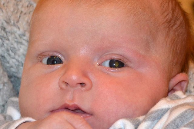 Symptoms of retinoblastoma - NHS