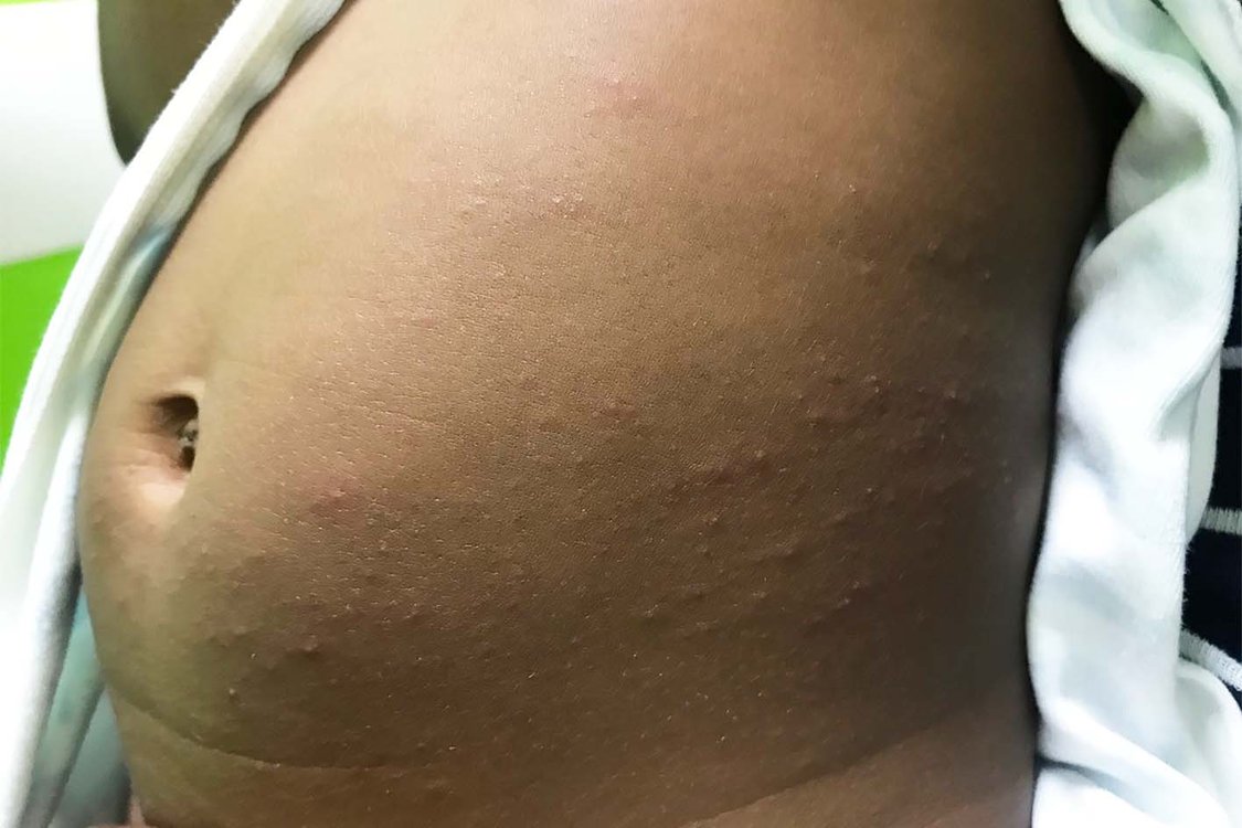 Heat rash (prickly heat) - NHS