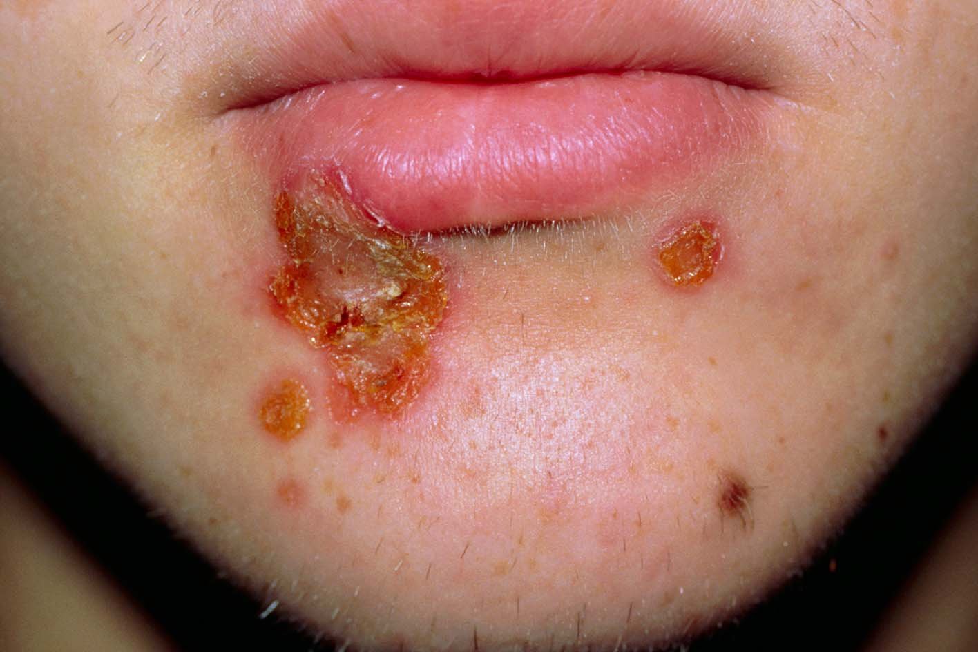 Impetigo - NHS