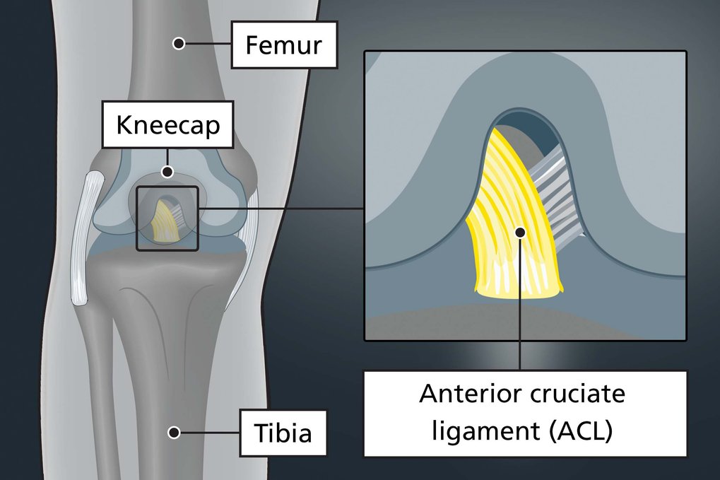 What is ACL (anterior cruciate ligament) surgery? - NHS