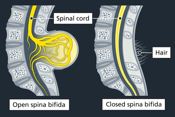 Photos De Spina Bifida In Utero Surgery Improves Outcomes For Babies